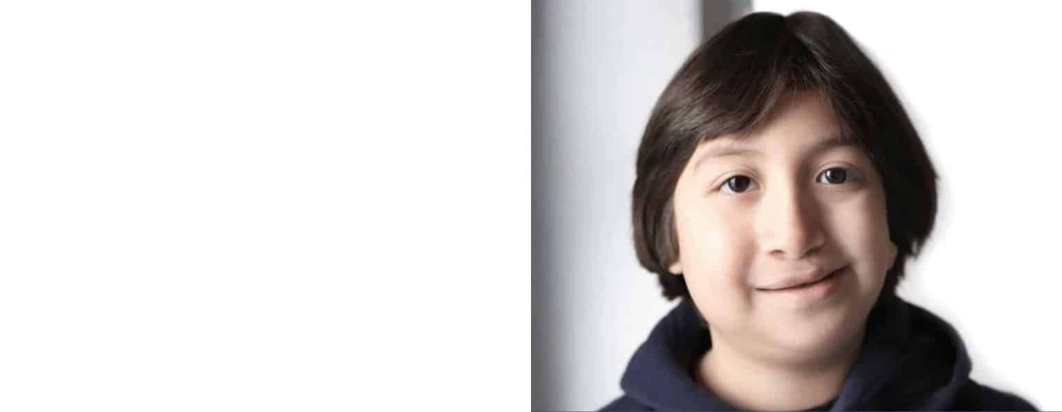 What are Craniofacial Differences? | myFace